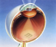 Cataract Treatment San Mateo | Cataract Removal Surgery